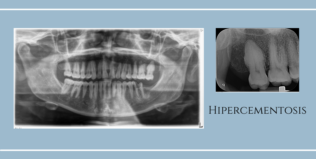 Hipercementosis en segundo molar superior izquierdo